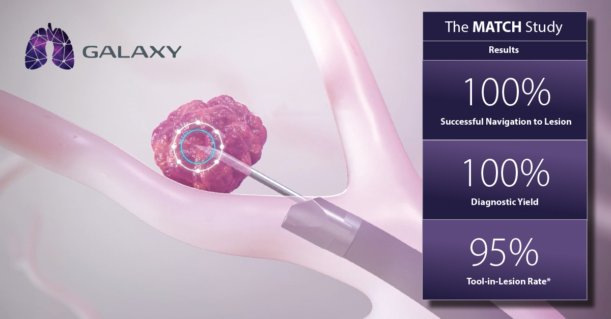 First-in-Human Clinical Trial of the Galaxy System - FRONTIER STUDY